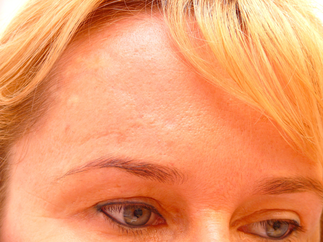 litteken na beh · Mary Smits Huidtherapie en Lasertherapie Helmond