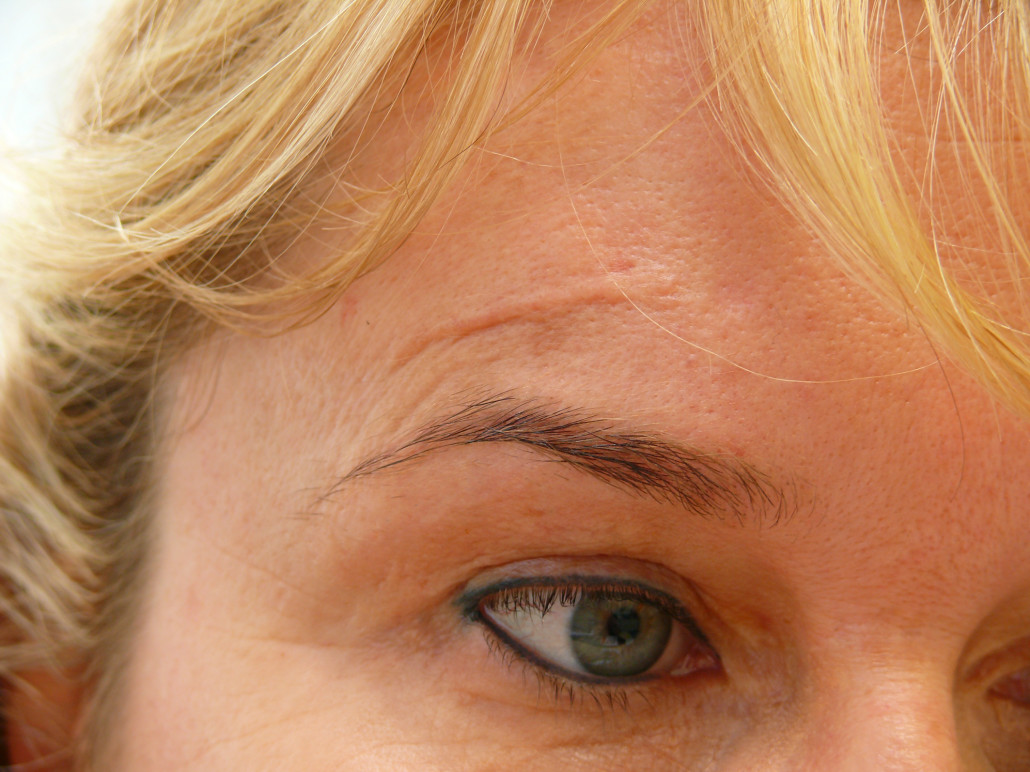 litteken voor beh · Mary Smits Huidtherapie en Lasertherapie Helmond